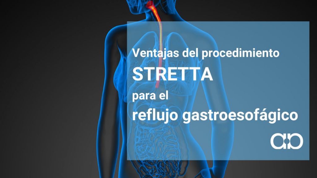 STRETTA, ventajas del procedimiento - Alberdi Aparato Digestivo